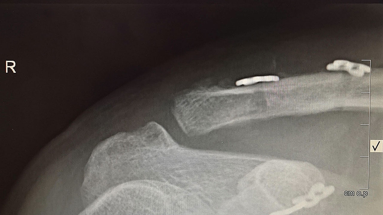 Akromioklavikulargelenk Articulatio Acromioclavicularis