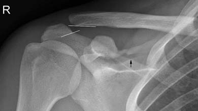 Akromioklavikulargelenk Articulatio Acromioclavicularis