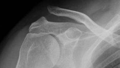 Akromioklavikulargelenk Articulatio Acromioclavicularis